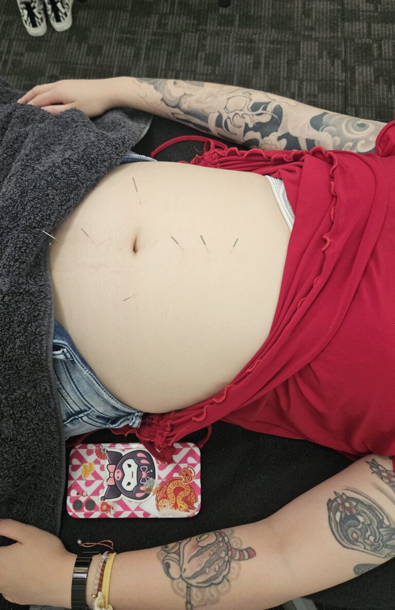 Acupuncture - Physio 360